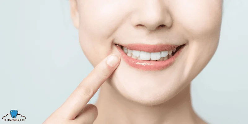 All-on-4 Dental Implants Overview: Benefits, Cost & Timeline